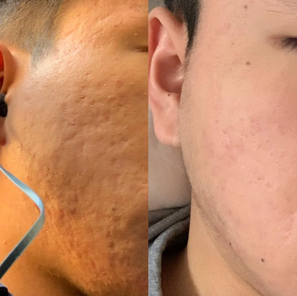 Skin Tightening - Virtue RF | Aesthetica Med Spa Skin Tightening - Virtue RF | Aesthetica Med Spa
