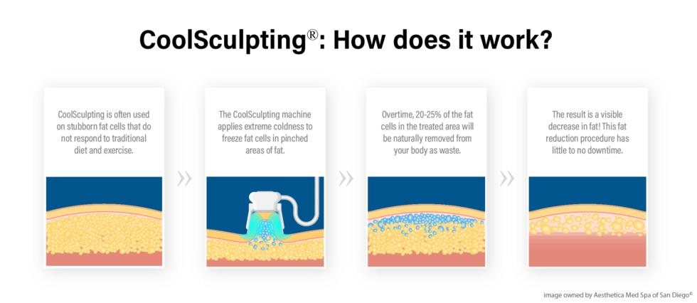 CoolSculpting San Diego Nonsurgical Fat Reduction